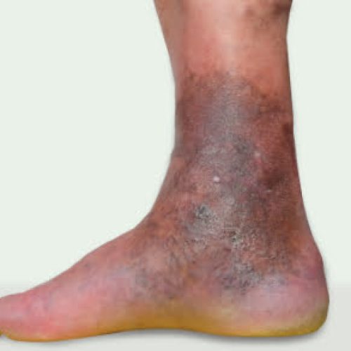 Stasis Dermatitis Causes Eczema Types: Stasis Dermatitis Diagnosis And