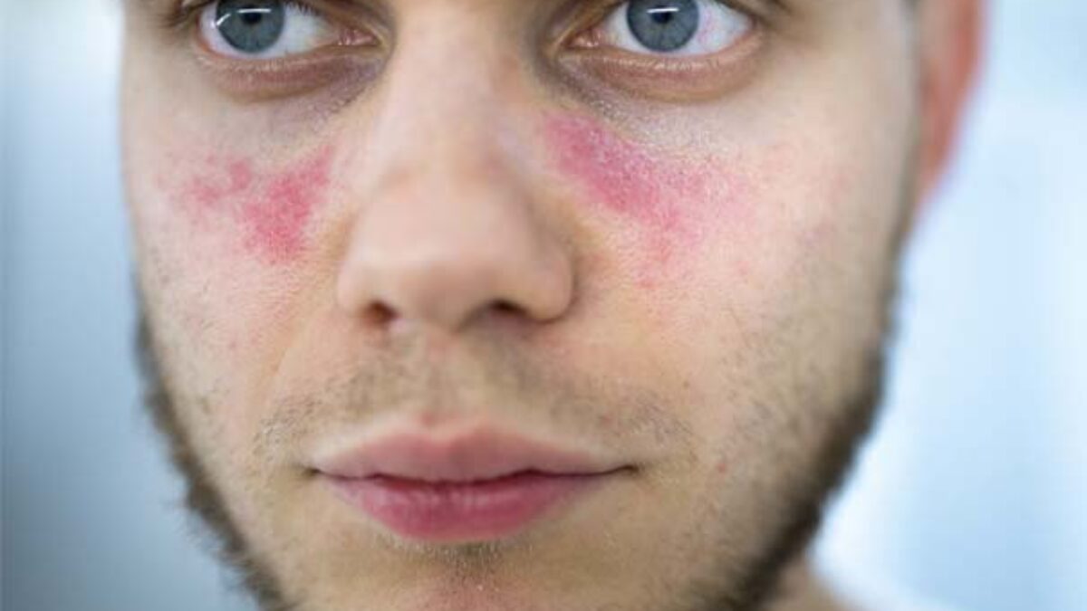 Cutaneous Lupus Face