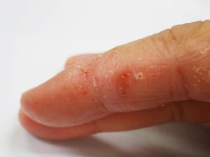 Dyshidrotic Eczema - Dermatology Group of The Carolinas