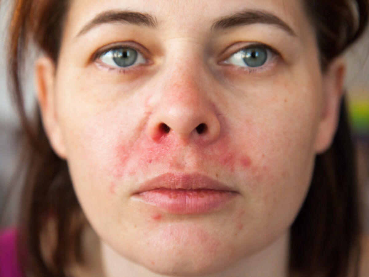 Periocular Dermatitis