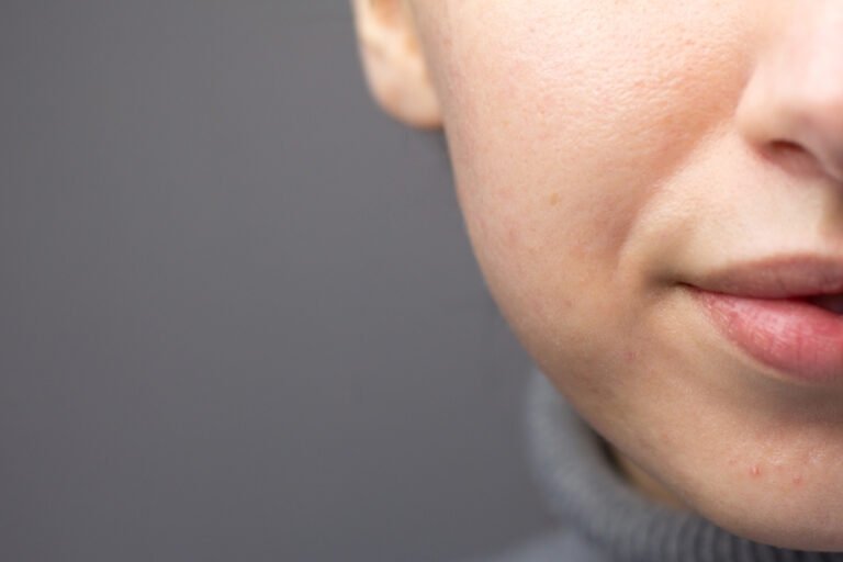 Decoding the Magic: How Does Isotretinoin Work for Clear Skin?